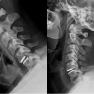 Bandscheibenprothetik – ONZ