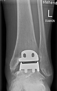 Sprunggelenks- & Fußchirurgie – ONZ