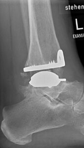 Sprunggelenks- & Fußchirurgie – ONZ