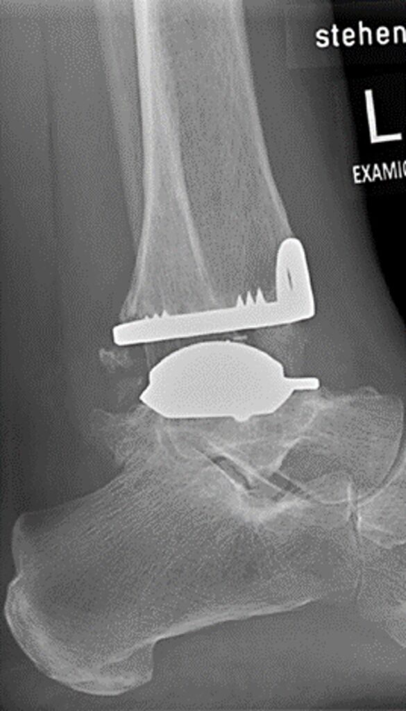 Sprunggelenks- & Fußchirurgie – ONZ